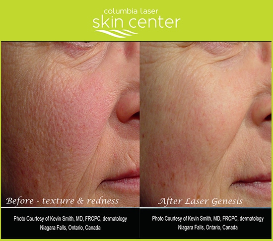 Laser Genesis - Before and After | Columbia Laser Skin Center