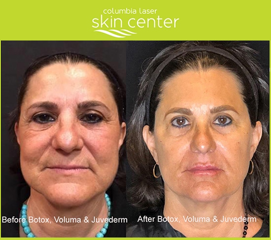 Botox Cosmetic in The Dalles, OR | Columbia Laser Skin Center