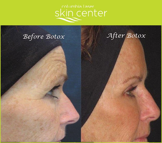 Botox Cosmetic - Before and After - Columbia Laser Skin Center
